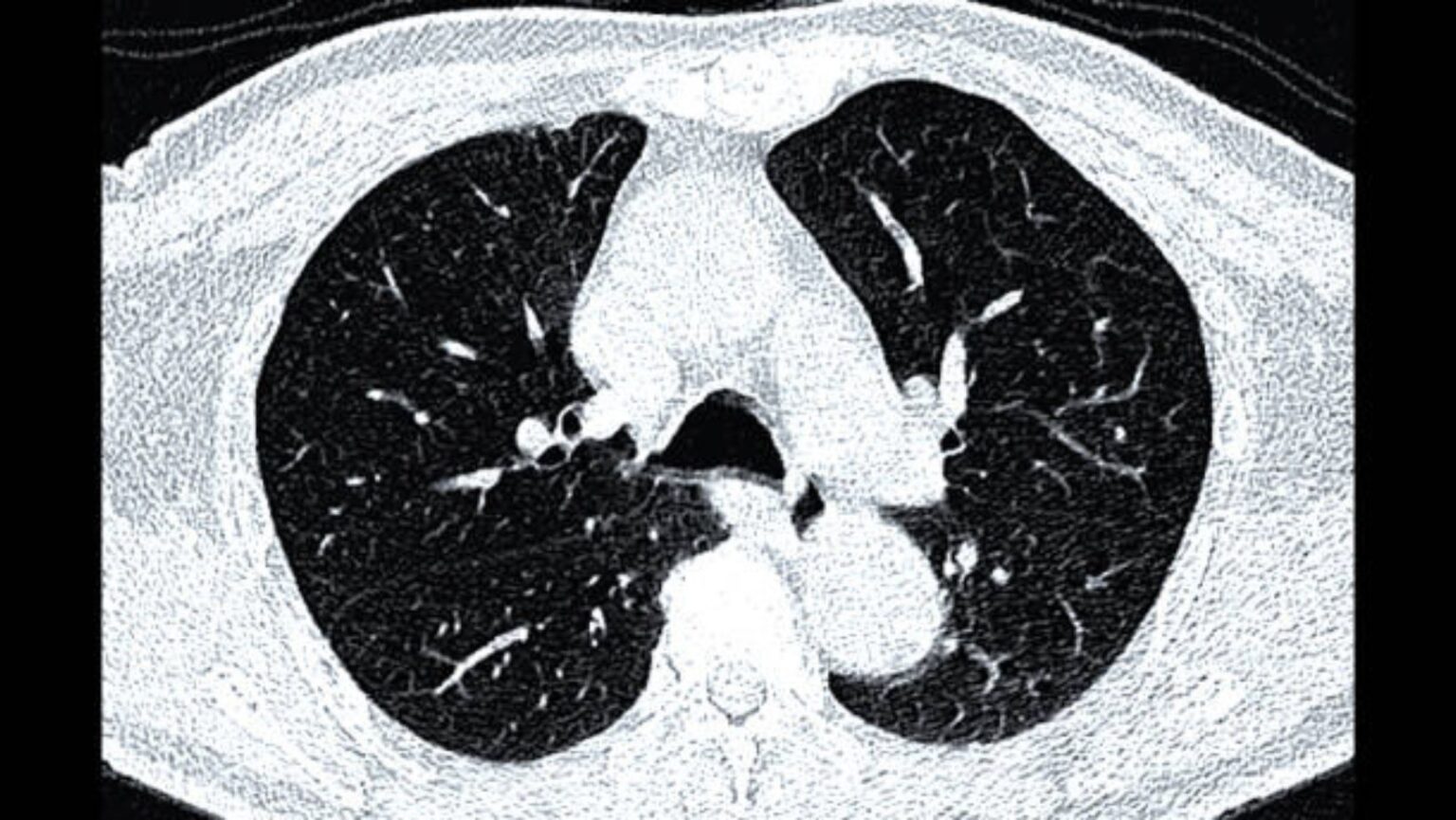 Understanding Lung Nodules: Akciğerde 7 mm Nodül Var Korkuyorum ...
